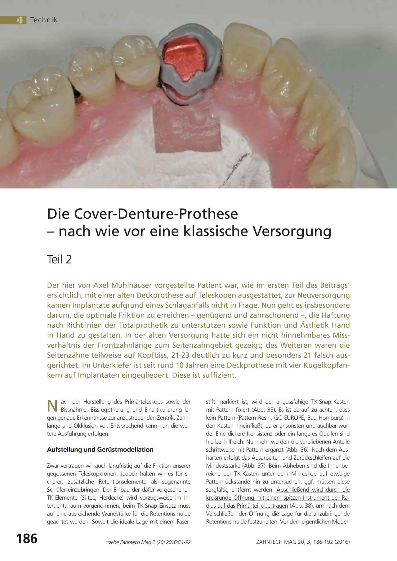FB | Die Cover-Denture-Prothese Teil 2 › Komet Magazin